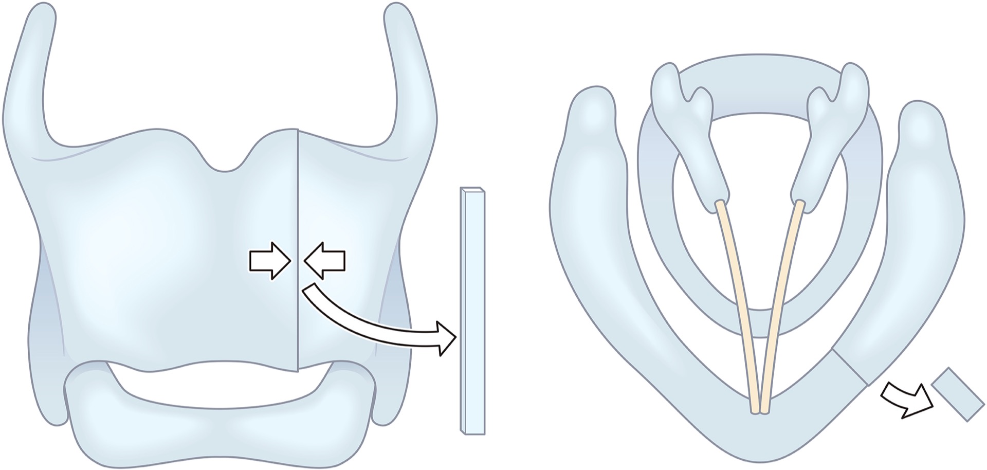 Type III Thyroplasty :: THE METROPOLITAN ENT SURGICLINIC TOKYO