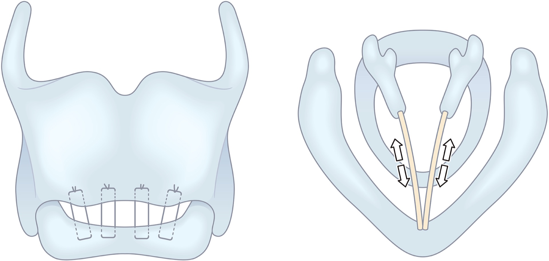 Type IV Thyroplasty :: THE METROPOLITAN ENT SURGICLINIC TOKYO